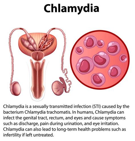 Strep Throat Vs Chlamydia Spotlight On Symptoms And Strategies