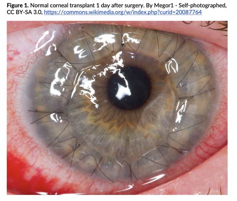Em3am Corneal Transplant Complications Emdocs
