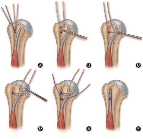 Schematic Diagram Of The Arthroscopic Modified Double‐row Biceps