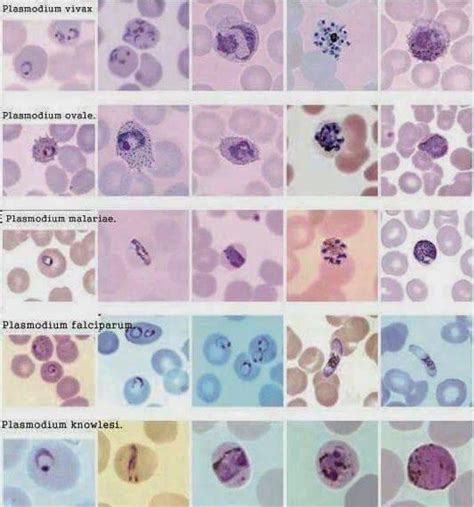 Identification Of Different Forms Of Malaria Parasites In Thick And