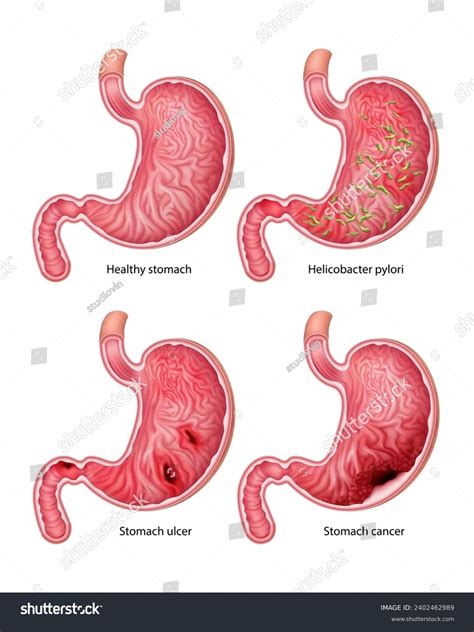 Stomach Diseases Isolated Vector Illustration Stock Vector Royalty