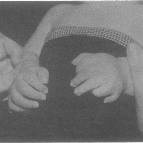 X Ray Ofleft Hand Showing Postaxial Polydactyly And Normal Thumb