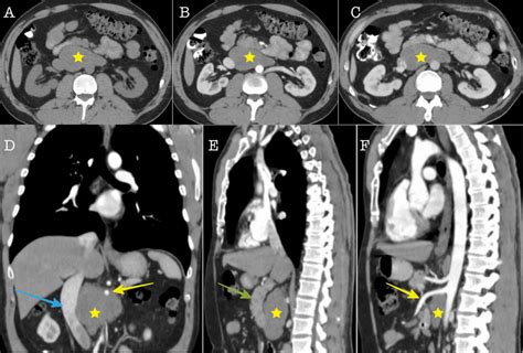 Cross Sectional Imaging A Axial Ct Without Contrast Medium B Download Scientific Diagram