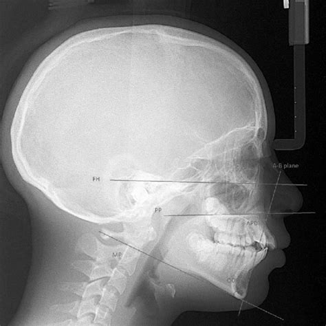 Pdf Overbite Depth Indicator And Anteroposterior Dysplasia Indicator Cephalometric Norms For