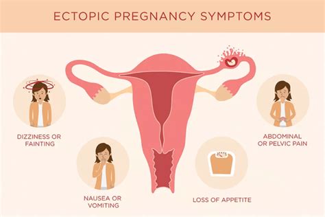 Ectopic Pregnancy Causes Symptoms And Treatment Public Health Notes