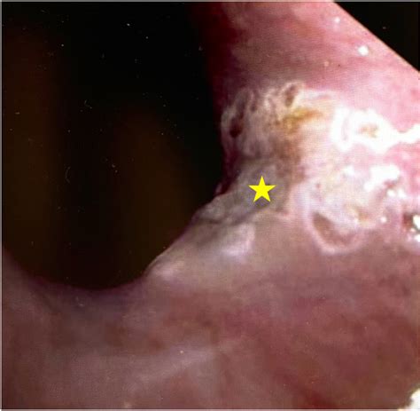 On Endoscopic Examination The Cervical Inlet Patch Star Is Download Scientific Diagram