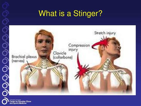 Ppt The Sidelines Evaluation Management And Prevention Of Neck