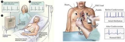 Cardioversion Queensland Cardiology