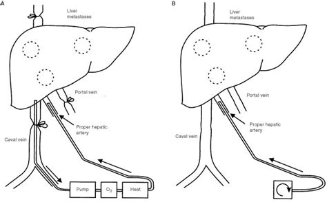 Schematic Representation Of A An Isolated Hepatic Perfusion Ihp And Download Scientific