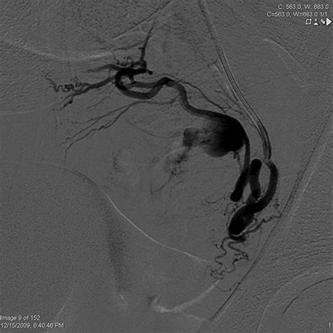 22 Year Old Female With Uterine Artery Pseudoaneurysm Dsa Image Download Scientific Diagram