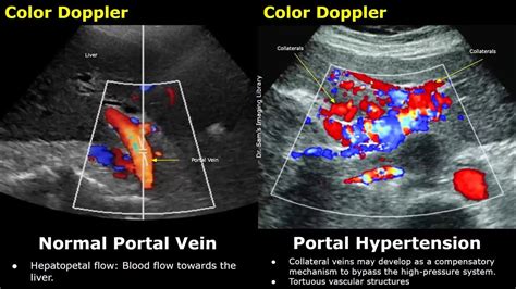 Portal Vein Color And Spectral Doppler Ultrasound Normal Vs Abnormal Images Liver Vascular Usg