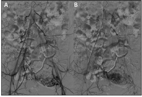 Case Report Embozene™ Microspheres For Uterine Avm Embolization Endovascular Today