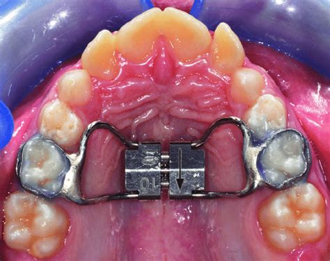 Conventional Rapid Maxillary Expander Download Scientific Diagram