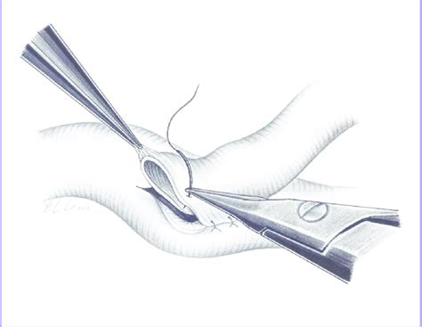 End To Side Arterial Anastomosis From Tan Bk Et Al J Plast Reconstr