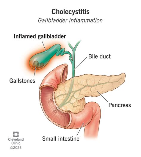 Chronic Diseases Chronic Acalculous Gallbladder Disease