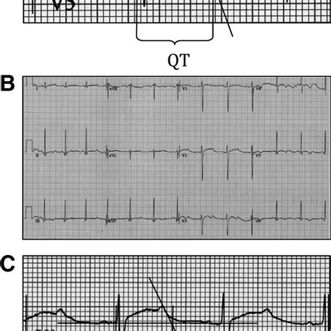 Measurement Of The Qt Interval A Use Of The Maximum Slope Technique Download Scientific