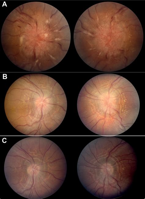 Long Term Results Of Optic Nerve Sheath Fenestration For Idiopathic Intracranial Hypertension