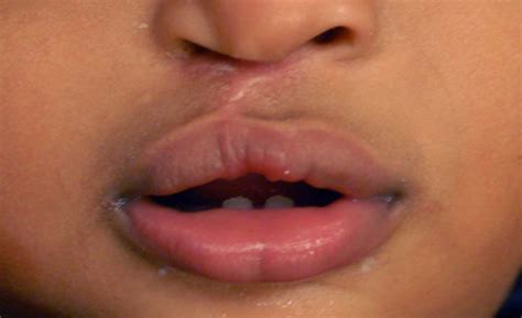 Cleft Lip And Cleft Lip Revision 4 Alaska Facial Plastic Surgery And Ent