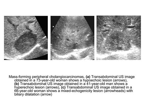 Diagnostic Imaging Of Cholangiocarcinoma Ppt Digestive Disorders Diseases And Conditions