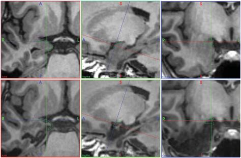 Segmentation Of Piriform Cortex On Pre Top Row And Post Bottom Row Download Scientific