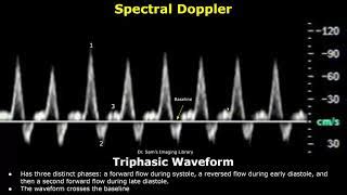 Abnormal Doppler Waveforms