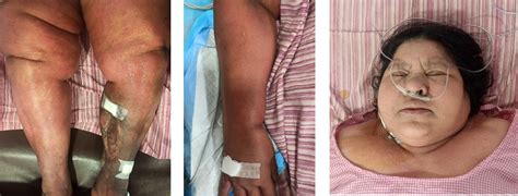 Dermatologic Emergencies Case Series Successful Management Of Ten And