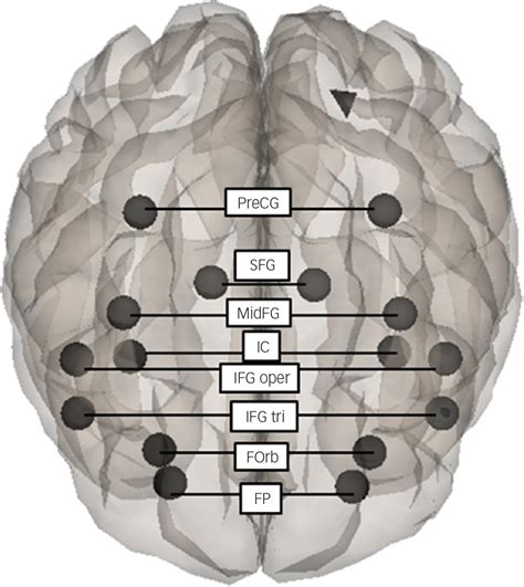Interhemispheric Functional Disconnection Because Of Abnormal Corpus