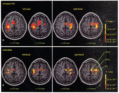 Statistical Parametric Maps Of Brain Activation The Upper Panel Shows Download Scientific