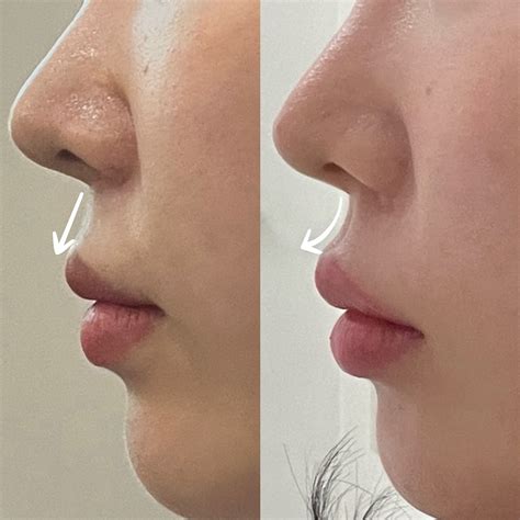 유앤미 강남본점 실리프팅 이마필러 얼굴형교정 인중축소 일자로 뚝 떨어진 인중 C컬 인중 변신 인중축소시술은 일반 입술