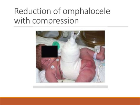 Abd Wall Defect Mx Pptx