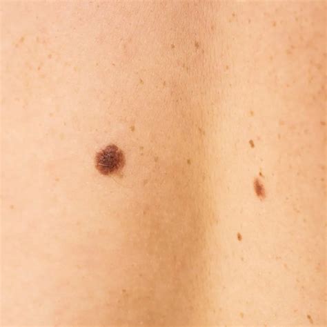 Melanocytic Nevus Dermoscopy Your Guide To Benign Moles Iboolo