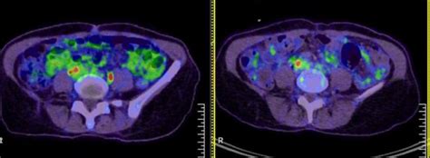 Persistence Of The Previously Noted Fdg Avid Right Common Iliac Node In Download Scientific
