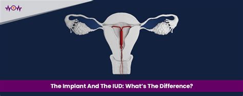 The Implant And The IUD What S The Difference WoW Health