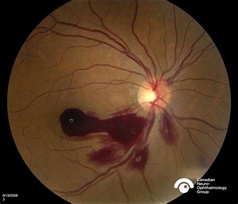 0101 Pre Retinal Hemorrhage Roth Spots Leukemiacanadian Neuro