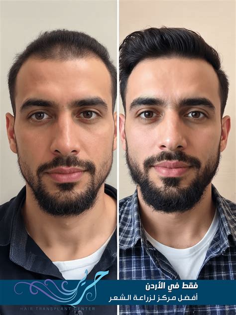 Hair Transplant Before And After In Jordan Real Results At Harir Hair
