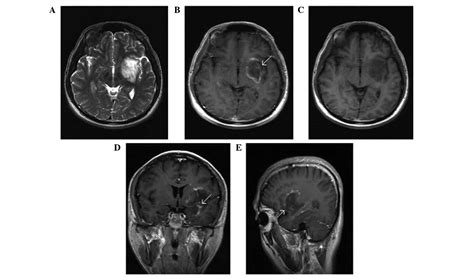 Cerebral Tumefactive Demyelinating Lesions