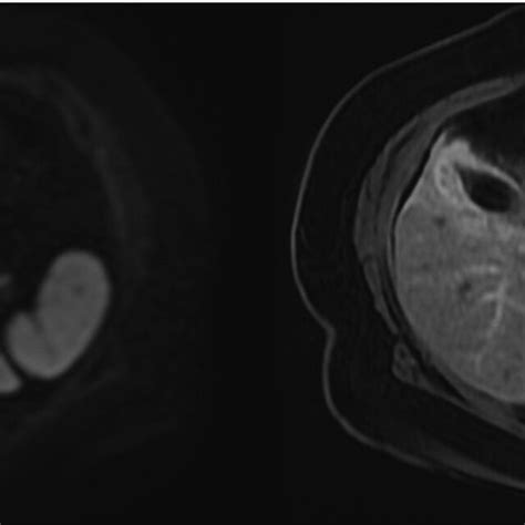 Irregular Fundal Gallbladder Wall Thickening With Invasion Of Adjacent Download Scientific