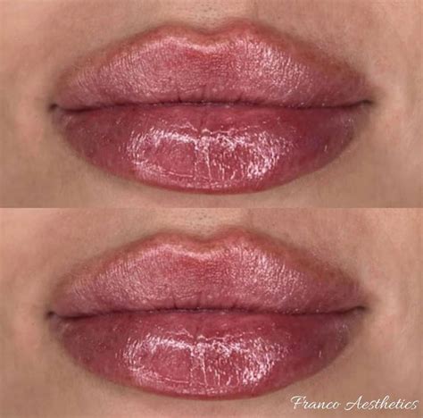 Before After Lip Fillers Franco Aesthetics