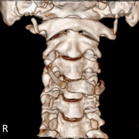 Volume Rendering Technique Vrt Reconstruction Of The Ct Download