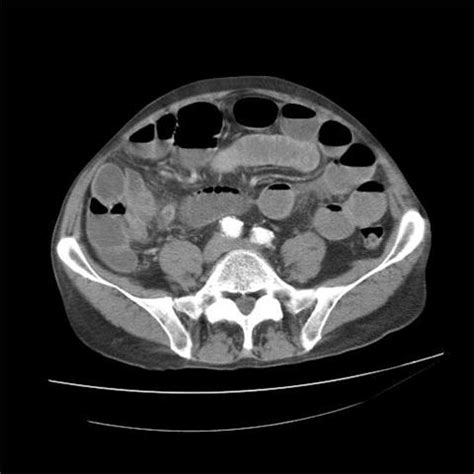 A Computed Tomographic Image Illustrating An Inflamed Appendix Arrow Download Scientific