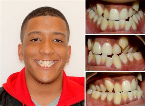 Crossbite Braces Before After