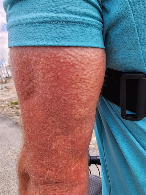 Cold Urticaria Whats Going On Rurticaria