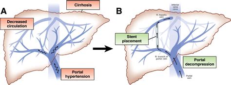 Using Transjugular Intrahepatic Portosystemic Shunts For Complications