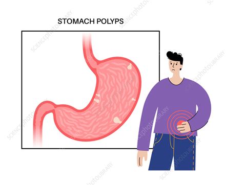 Stomach Polyps Illustration Stock Image F0365557 Science Photo Library