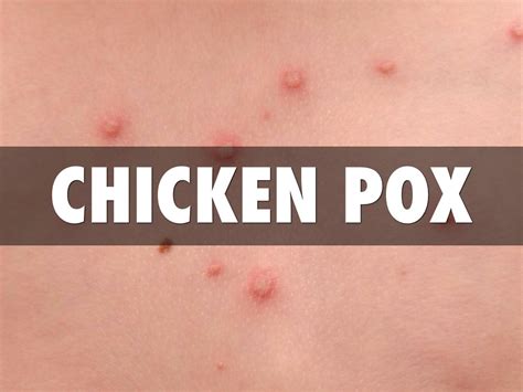 Chicken Pox By Marco Contreras