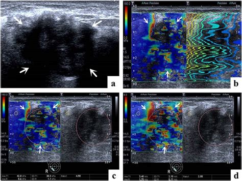 Invasive Ductal Carcinoma Ultrasound