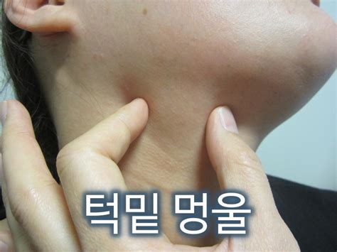 턱 밑에 목 아래 침샘 림프절 멍울 몽우리가 만져질 때 환자가 체크해 볼 수 있는 그리고 병원에서 의사가 고려하는 사항들 위드심의원 조우진 원장 네이버 블로그
