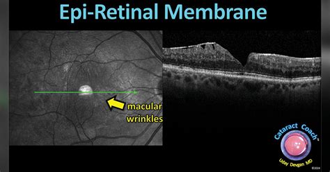 Oct Screening Needed Before Cataract Surgery