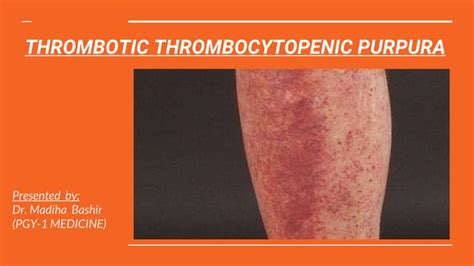 Thrombotic Thrombocytopenic Purpura 4pptx