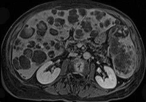 Case 213 Primary Splenic Angiosarcoma Radiology